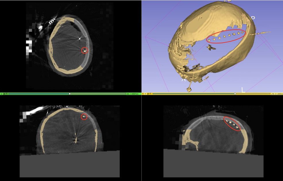Figure 10. Workflow Depicting the Sequential Steps in ECoG Localization ...