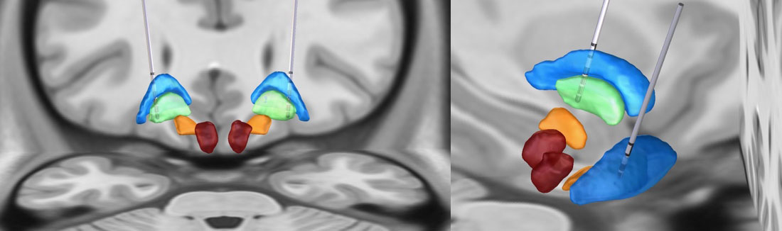 Figure 14. Illustration of DBS electrode locations in a subject who ...